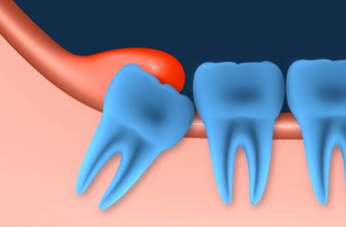 When Is It Necessary to Extract Wisdom Teeth? - Redcliffe Dental